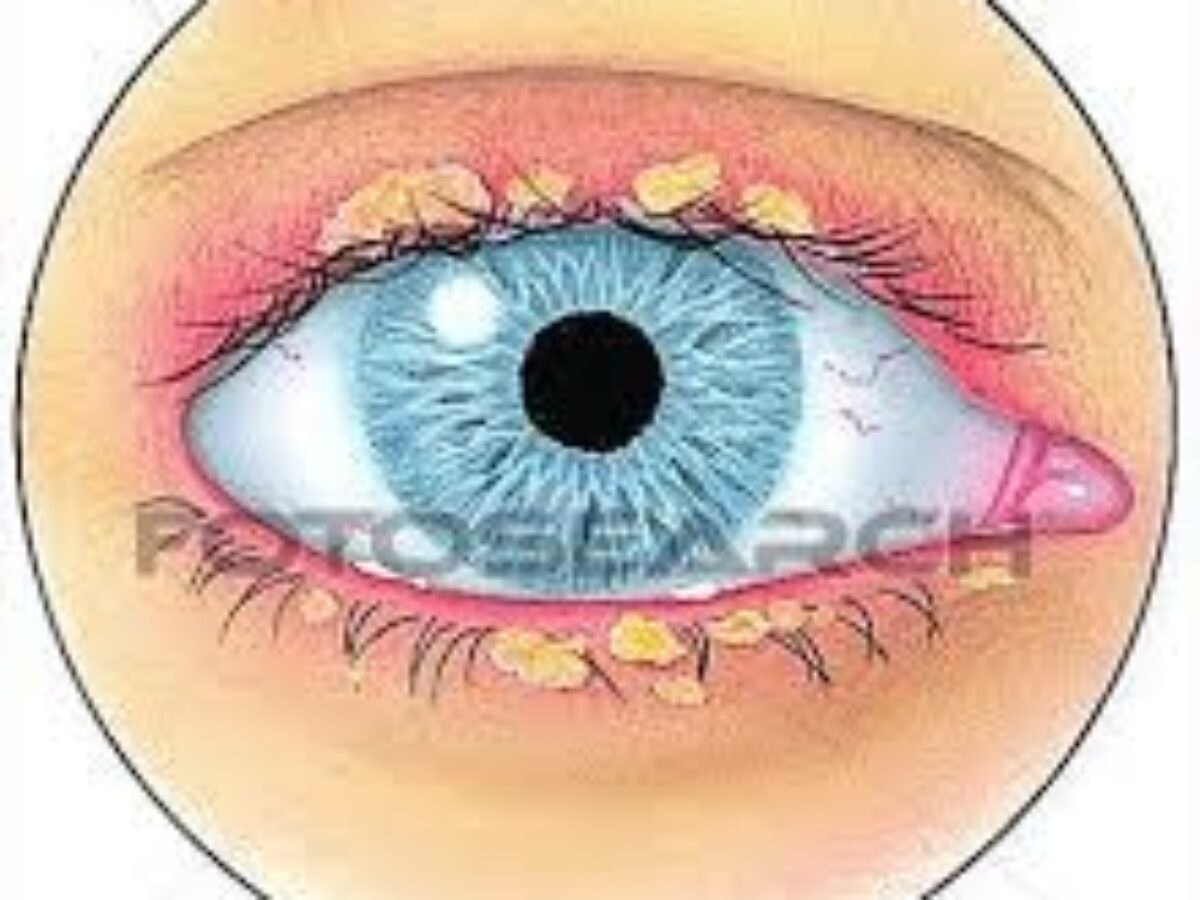 Ulcerative Blepharitis Definition