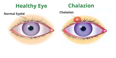 Treating a Chalazion (Chalazia) - TheraLife