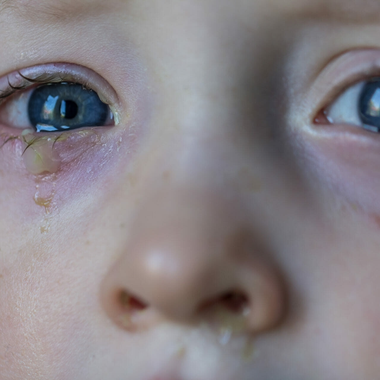 Newborn And Eye Discharge Newborn Jaundice Discharge Information