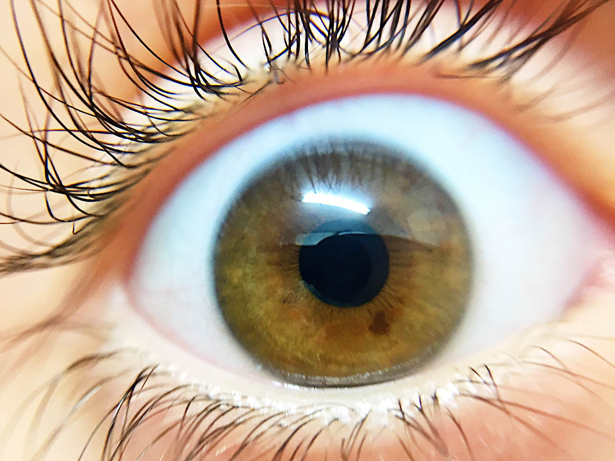 Remarkable Mucus String In Eye Treatment With TheraLife Remarkable Mucus String In Eye Treatment With TheraLife
