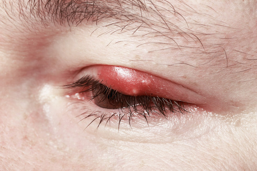 Amazing Stye- Treatment And Prevention