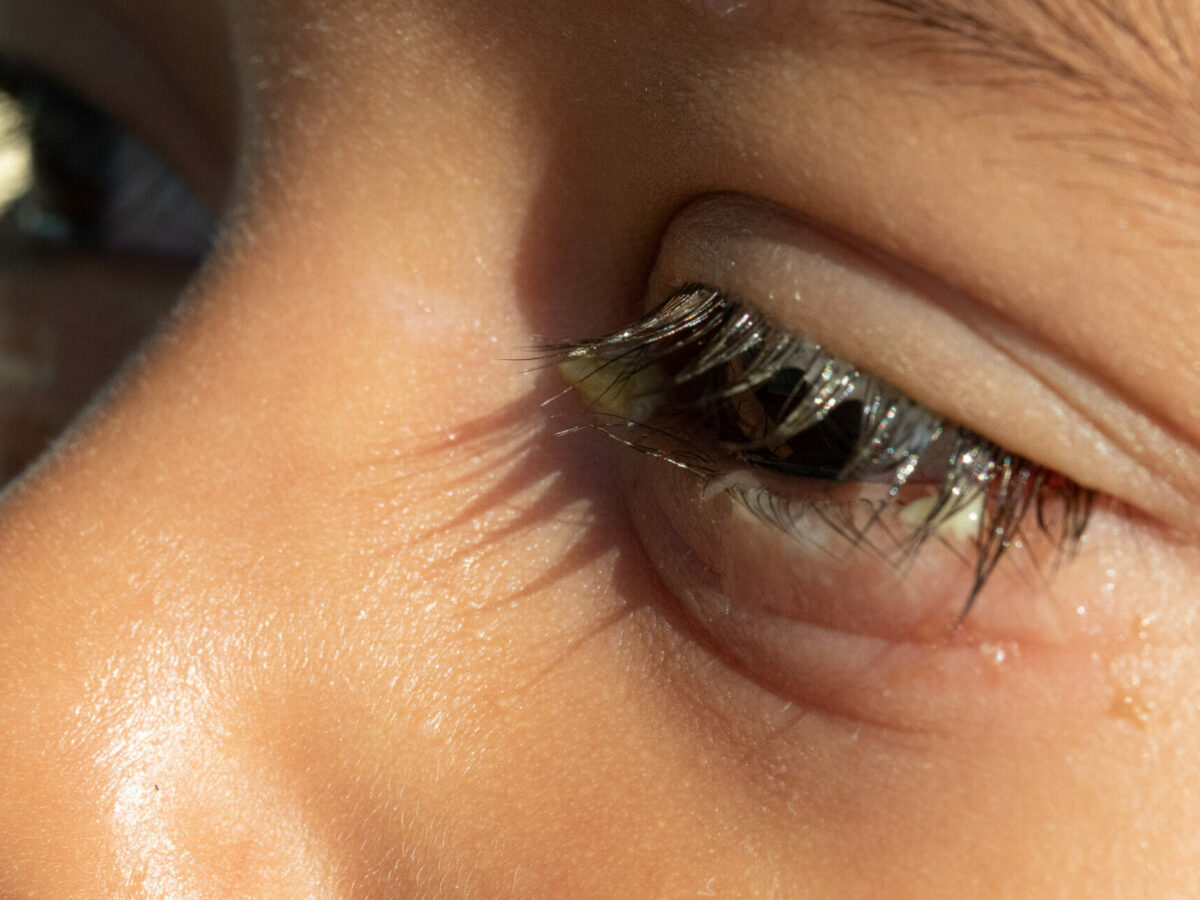 Eyelash Mite Infestation