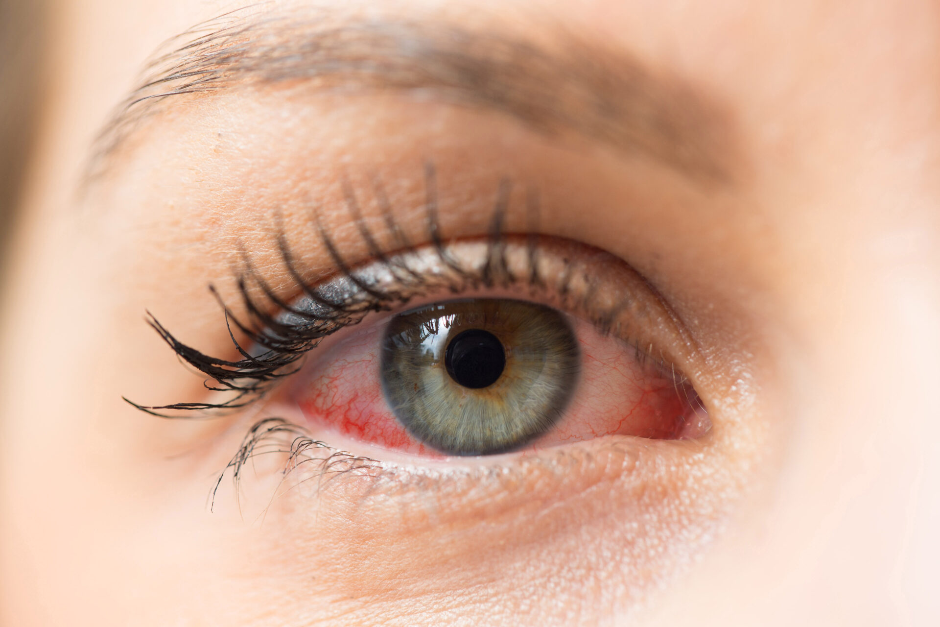 Amazing Ocular Rosacea - And Dry Eye Symptoms
